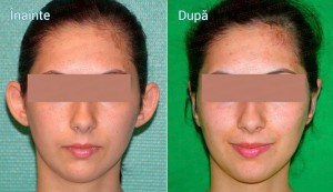 Otoplastie pentru urechi clapauge sau decolate - Dr. Vladislav Gyebnar