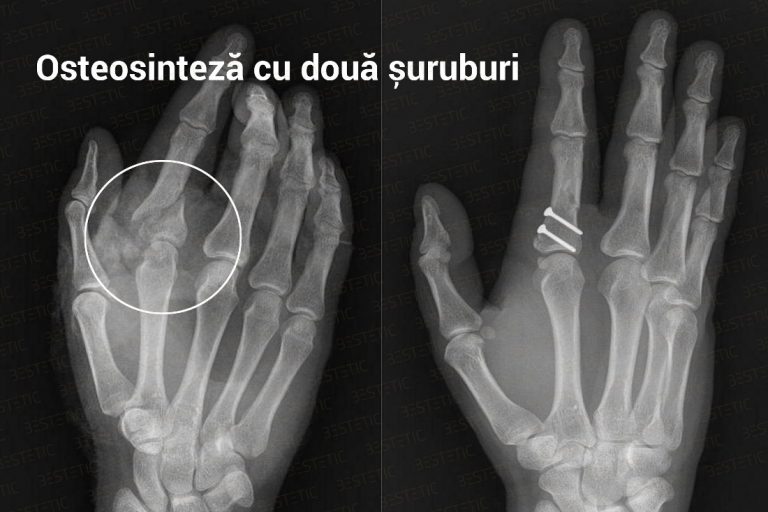 Fractura la mana si patologia osteo articulara a mainii - Clinica Bestetic