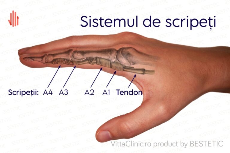 Deget în resort sau deget care se blochează - Vitta Clinic by BESTETIC